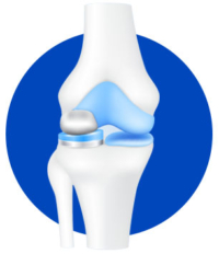 Jiffy Knee™ Procedure in Las Vegas | Quad-Sparing Knee Replacement at ...