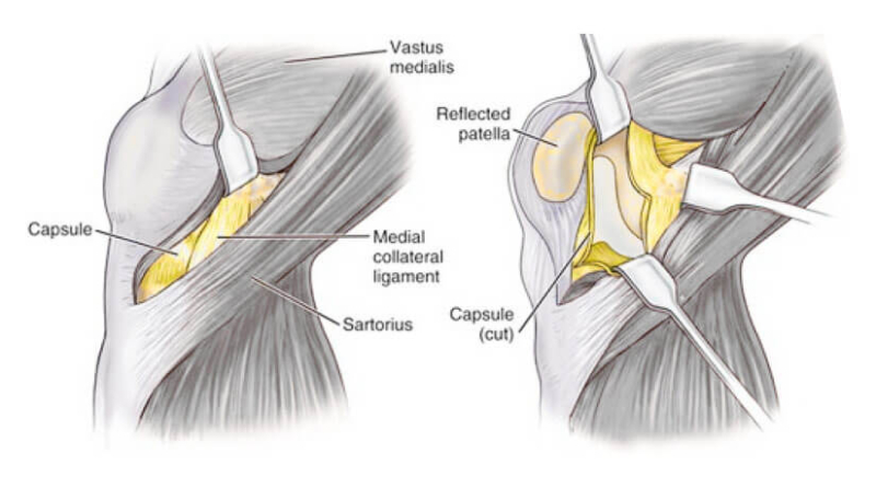 Jiffy Knee™ Procedure in Las Vegas | Quad-Sparing Knee Replacement at ...