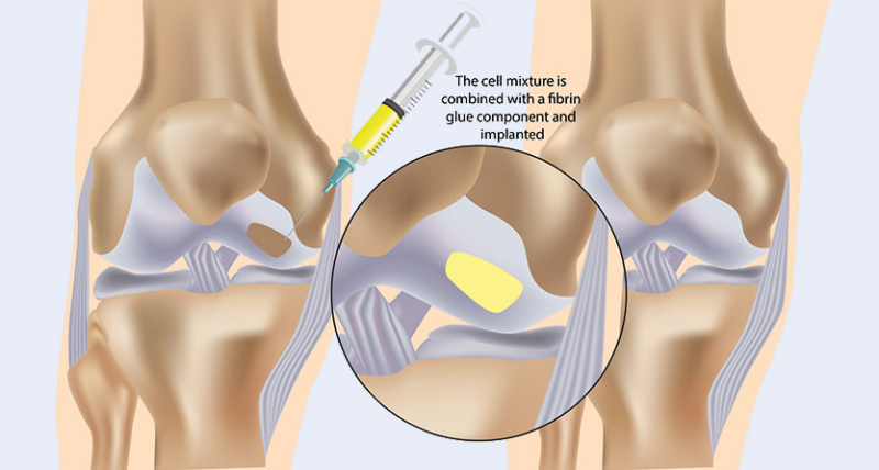 BMAC (Commonly called “Stem Cell Therapy”) in Las Vegas | Ortho Las Vegas